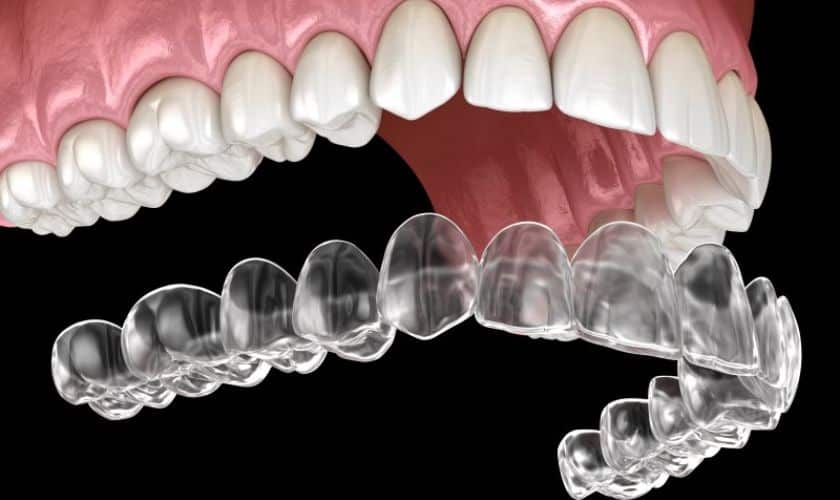 Invisalign Defends: Battling Bruxism Secrets